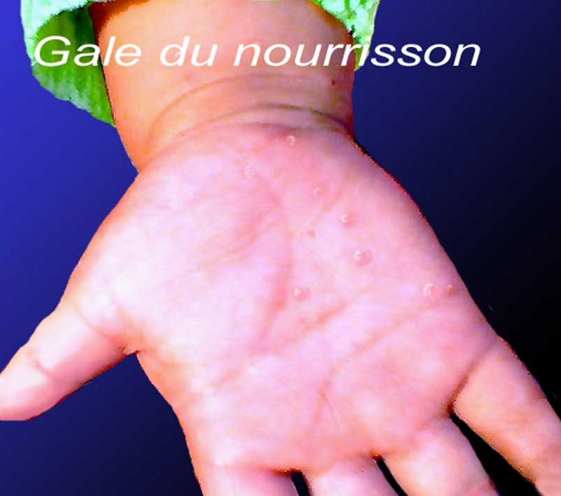 Comment Avoir La Gale Comment Avoir La Gale